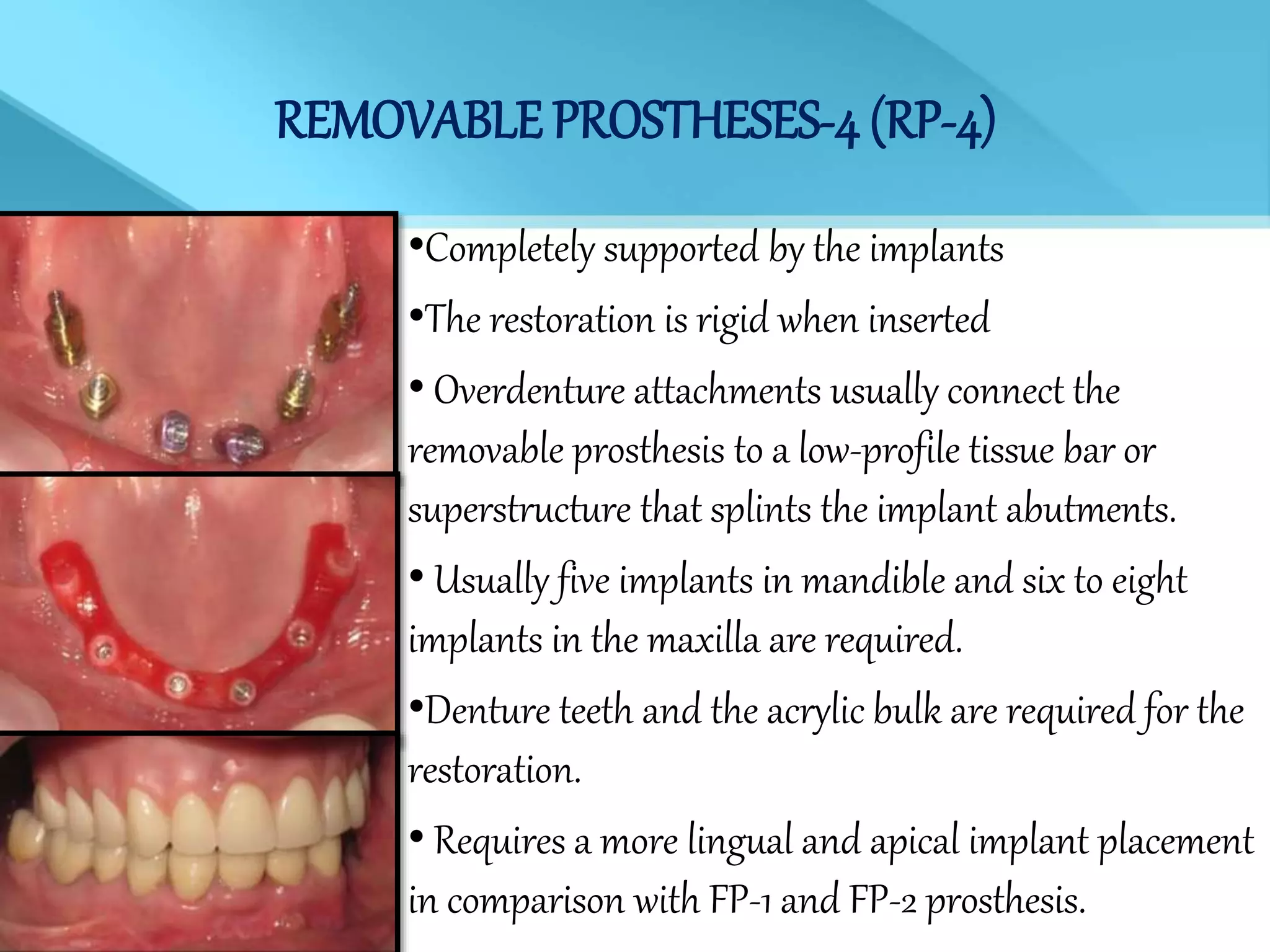 Implant supported overdentures | PPTX