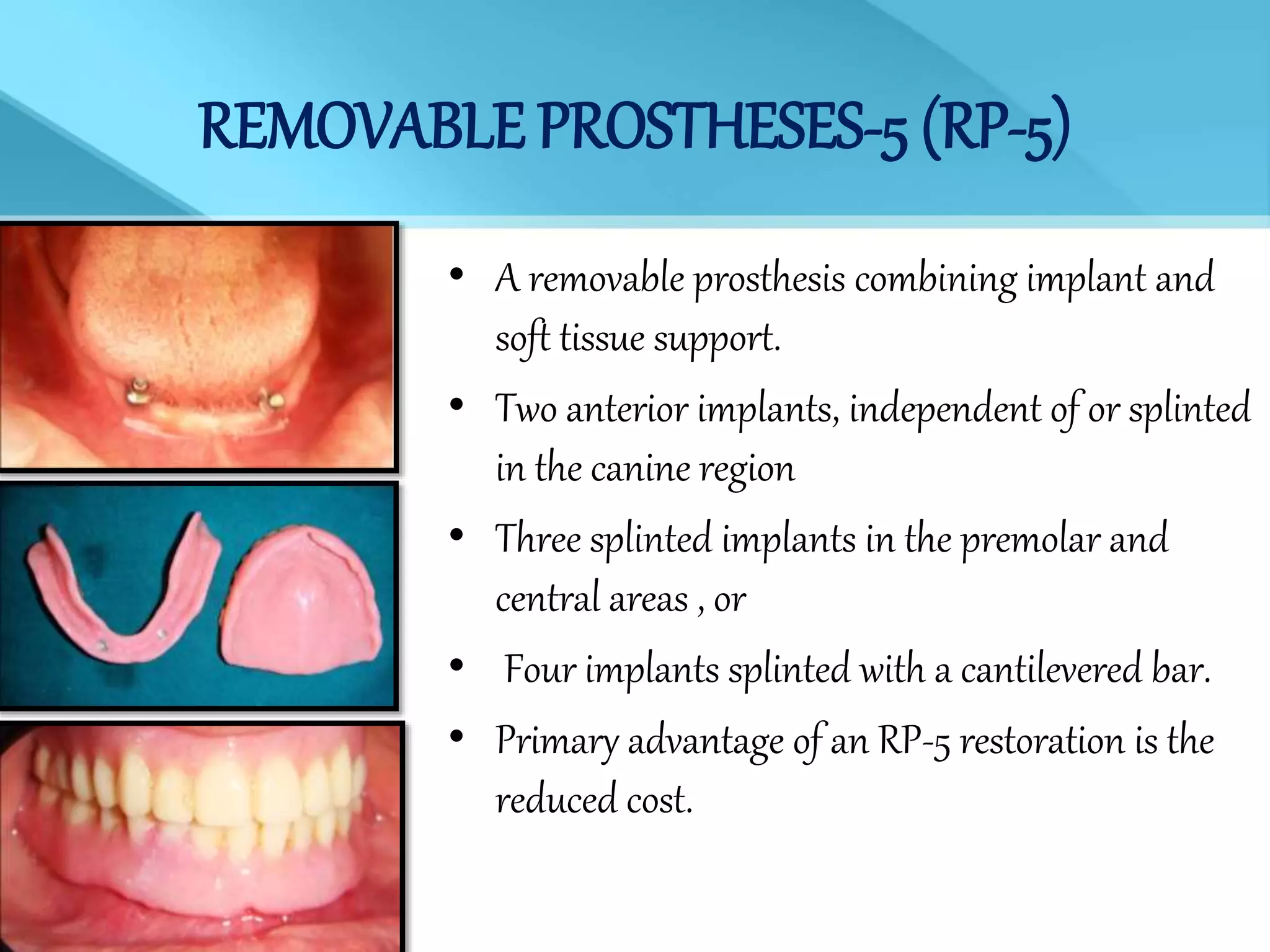 Implant supported overdentures | PPTX