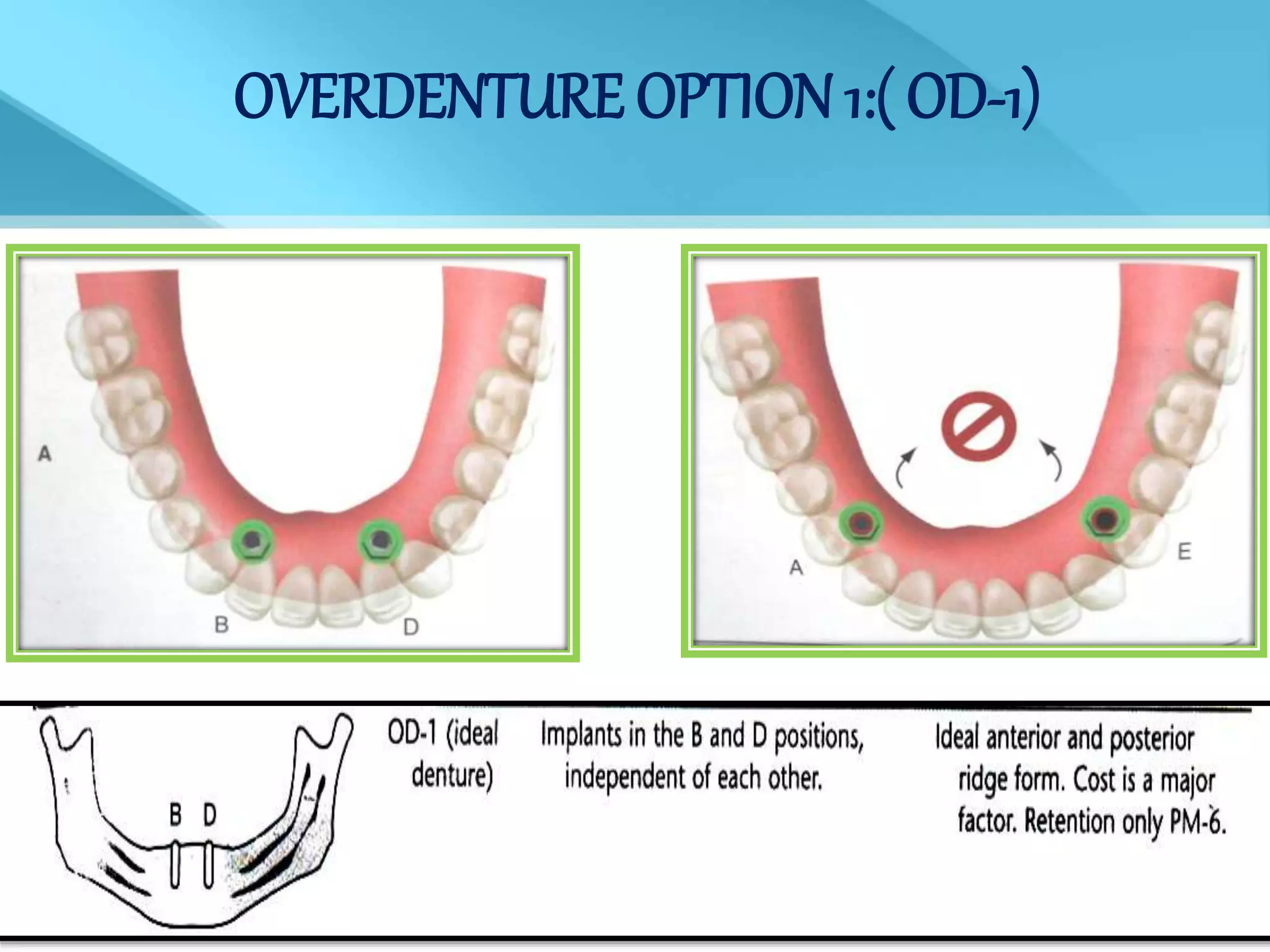 Implant supported overdentures | PPTX