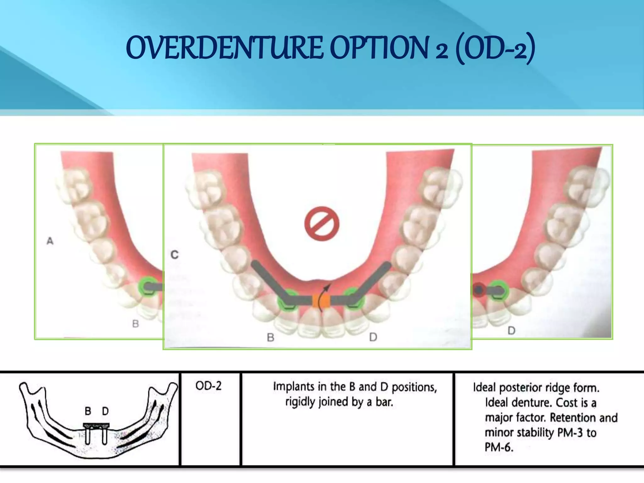 Implant supported overdentures | PPTX