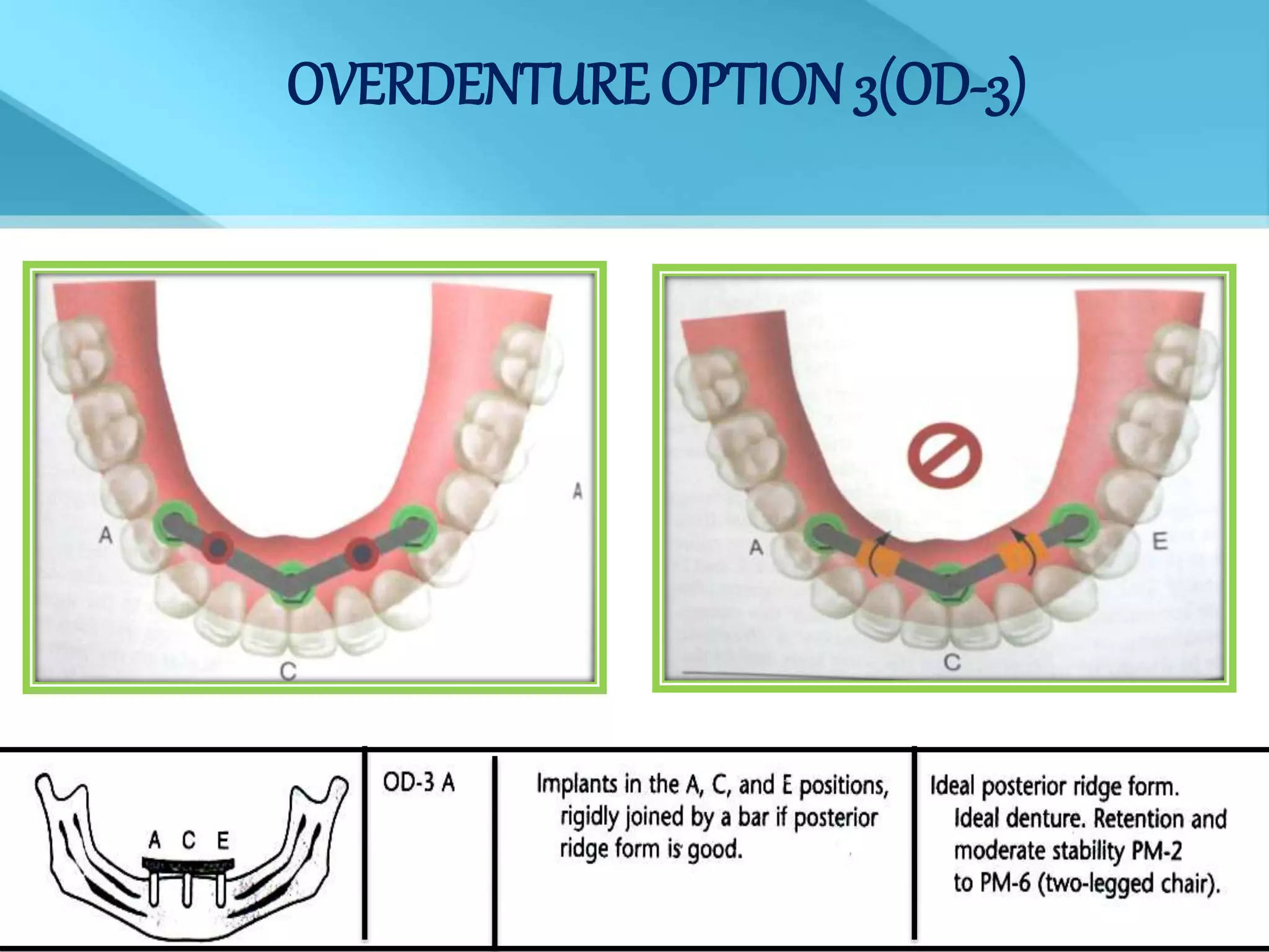 Implant supported overdentures | PPTX