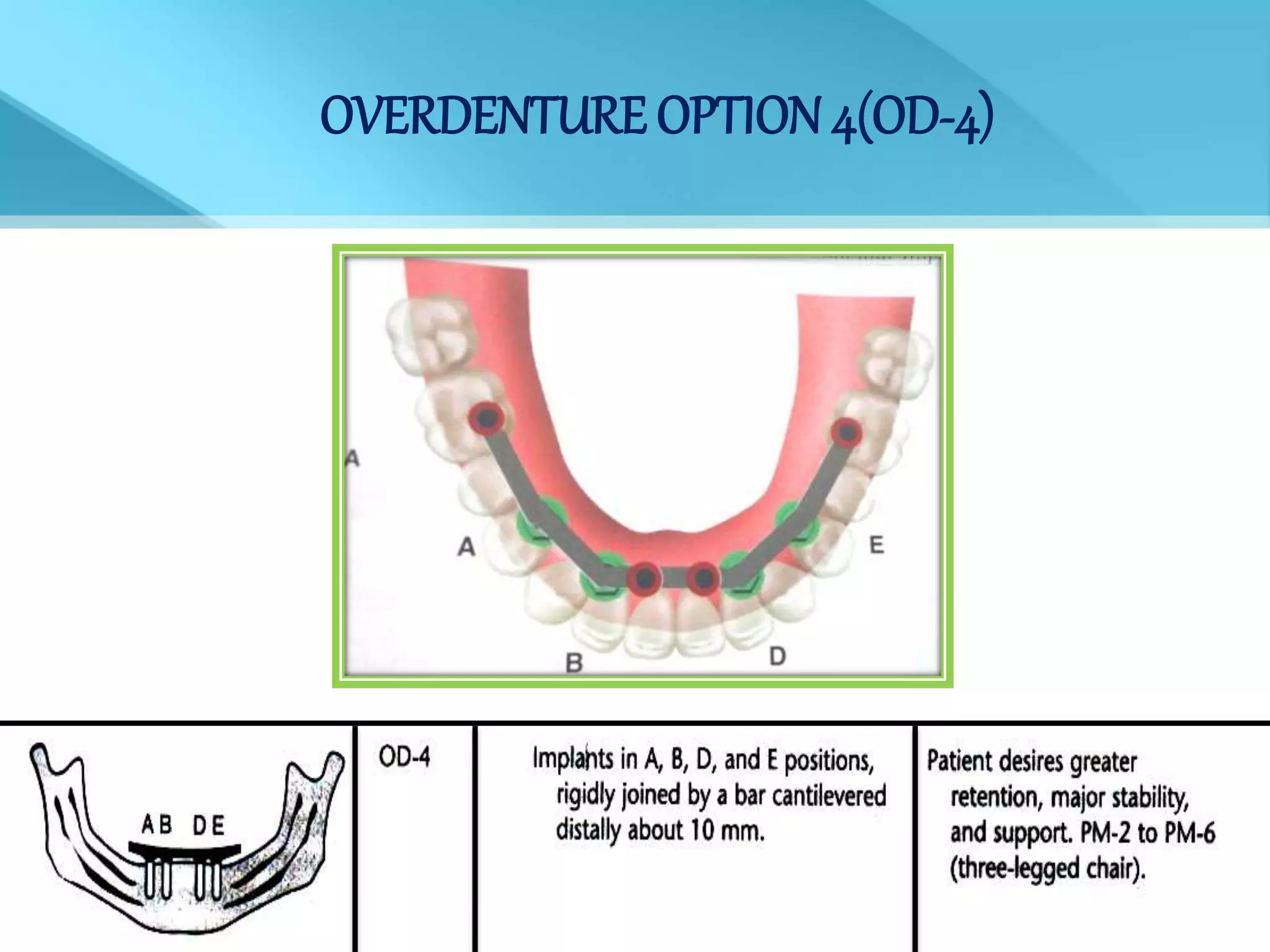 Implant supported overdentures | PPTX