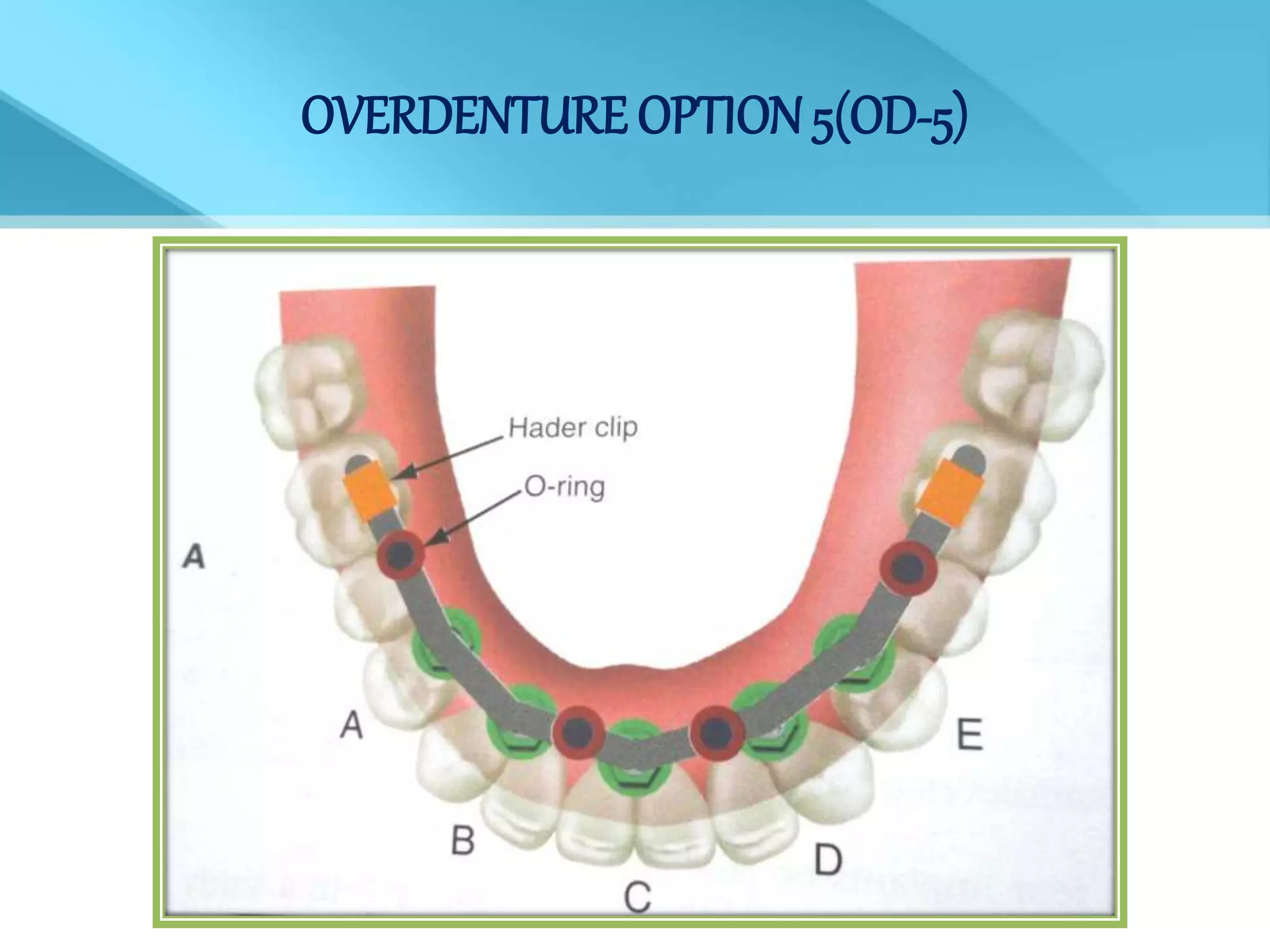 Implant supported overdentures | PPTX