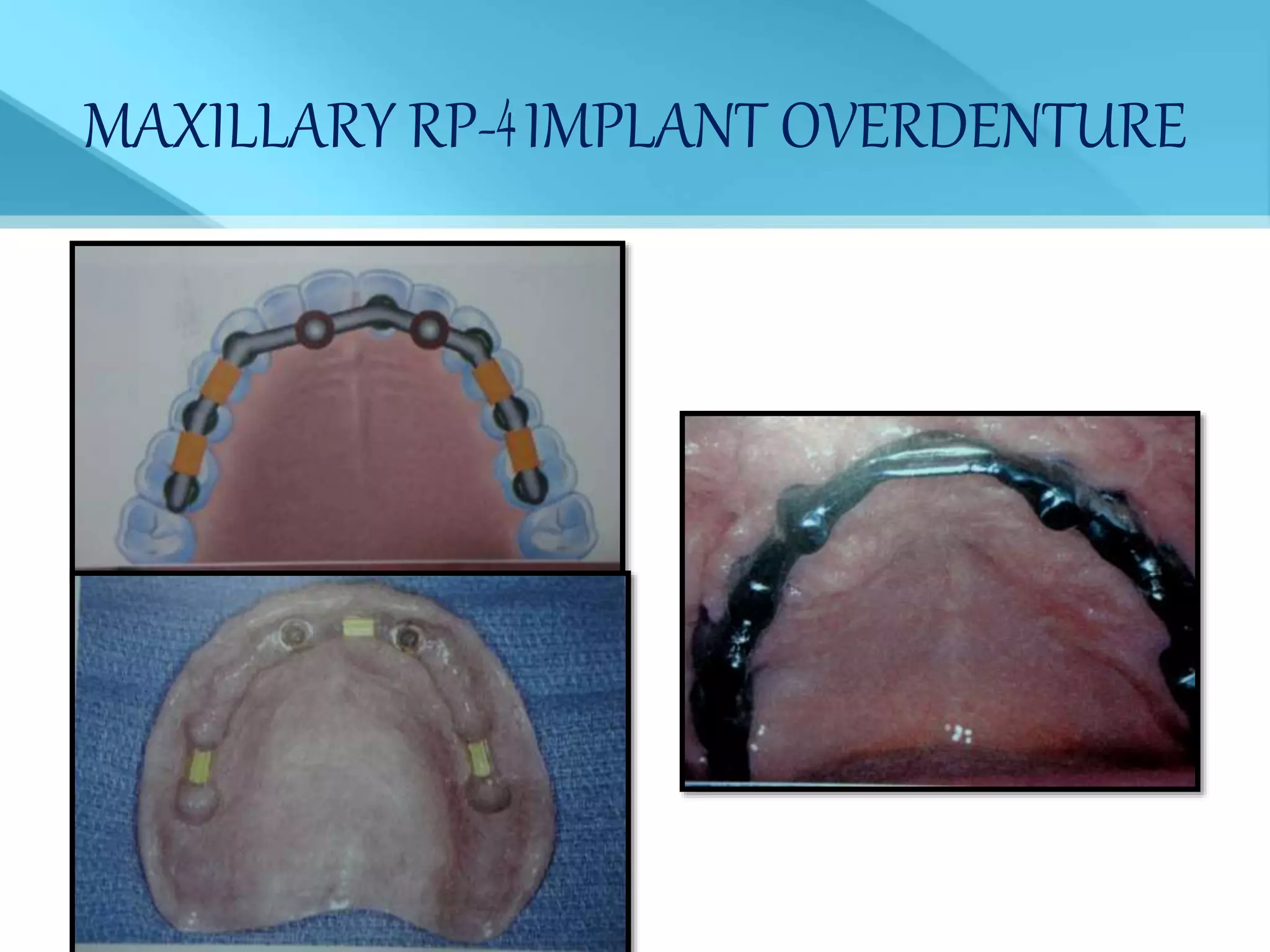 Implant supported overdentures | PPTX