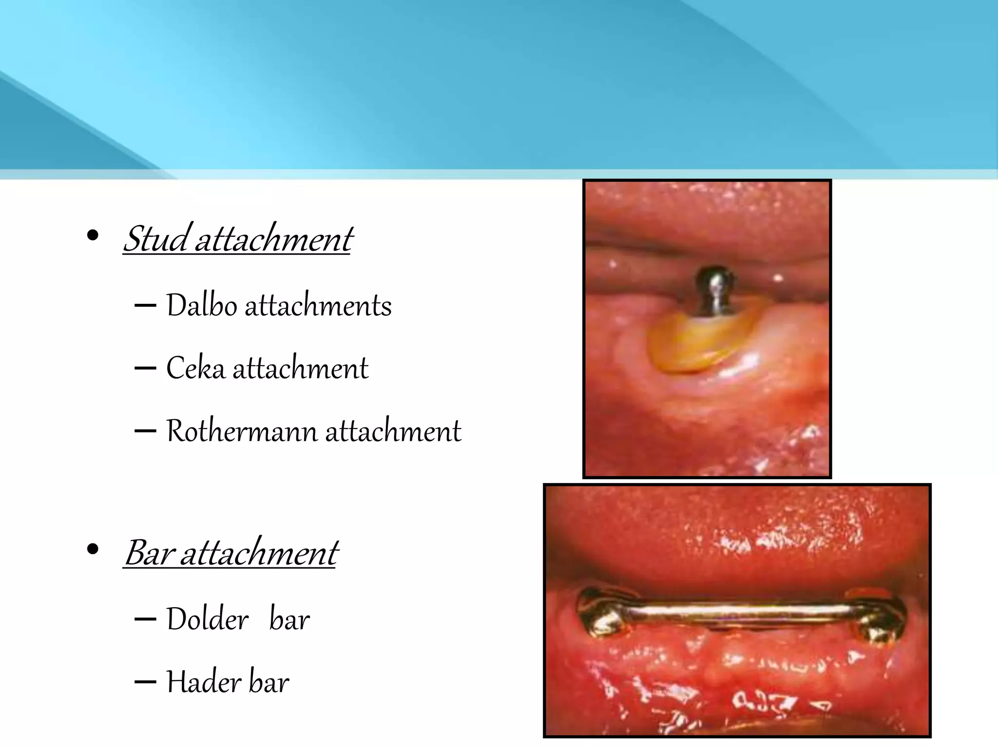 Implant supported overdentures | PPTX