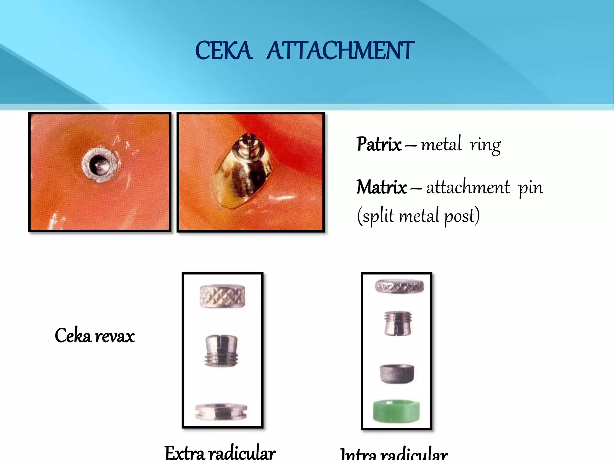 Implant supported overdentures | PPTX