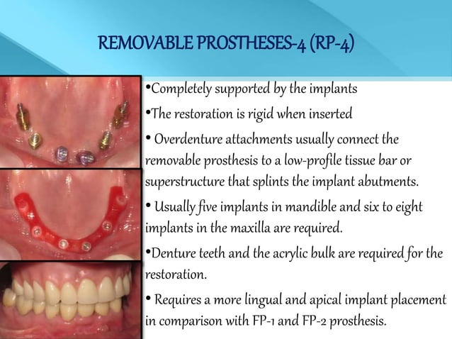 Implant supported overdentures | PPTX