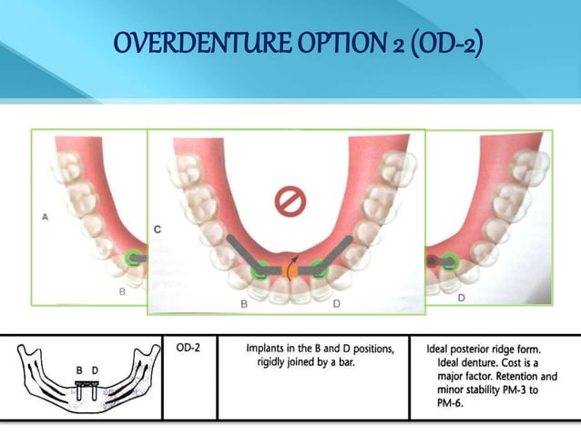 Implant supported overdentures | PPTX