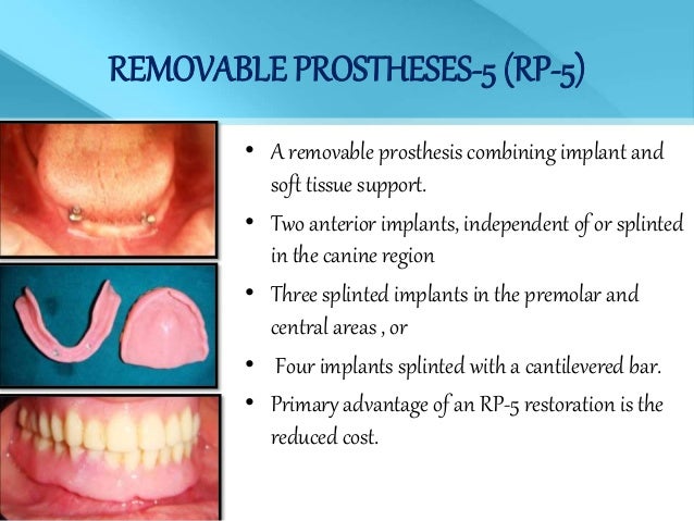 Implant supported overdentures