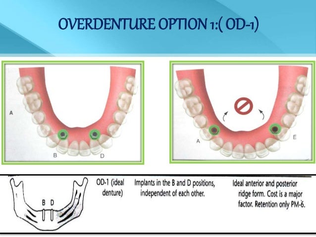 Implant supported overdentures
