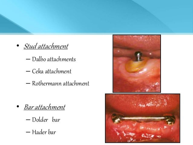 Implant supported overdentures
