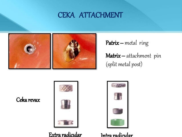 Implant supported overdentures