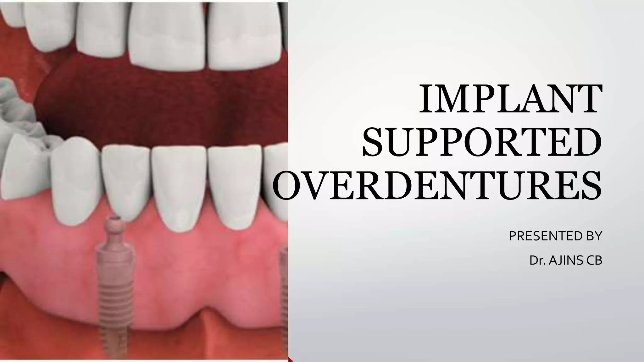 Implant Supported Overdentures | PPTX