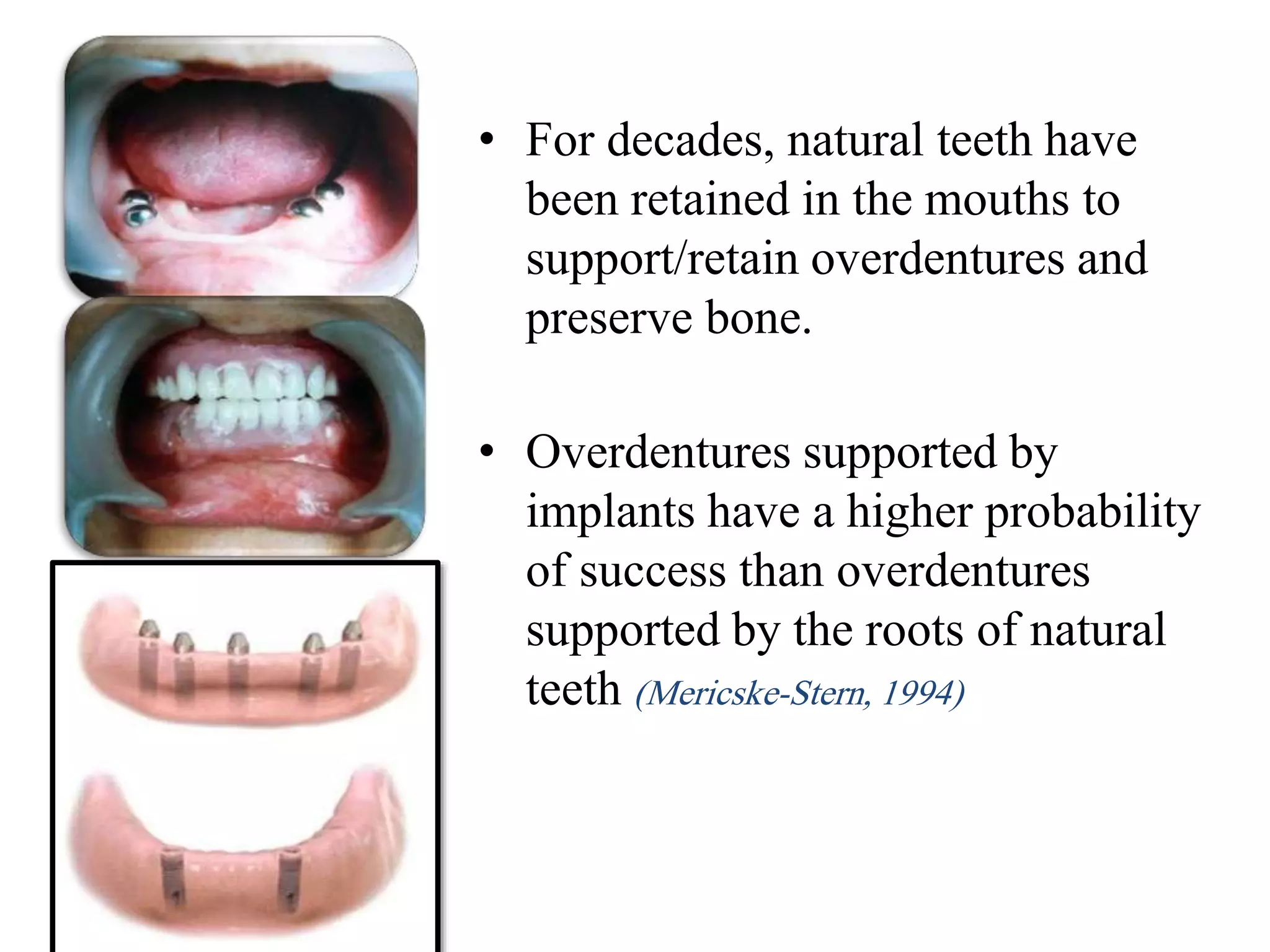 implant supported overdentures .pdf