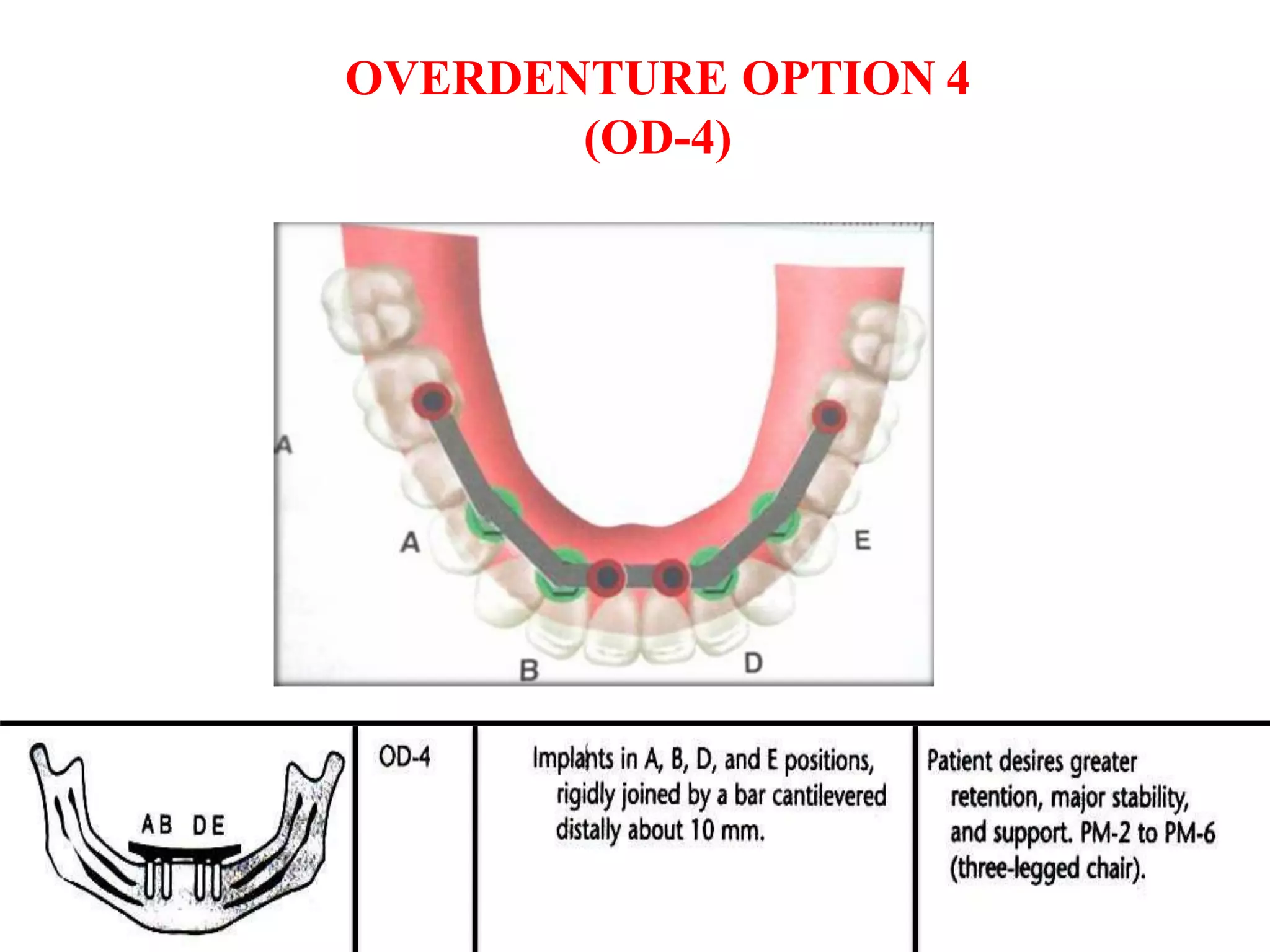 implant supported overdentures .pdf