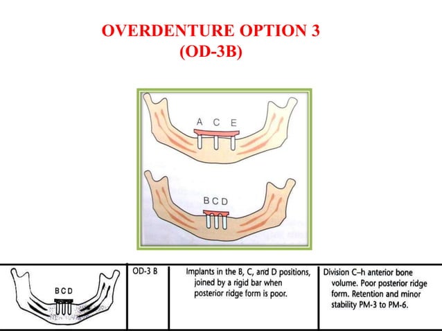 implant supported overdentures .pdf