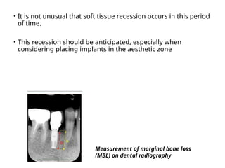 IMPLANT SURGERY 9 lecture in stomatoo.pptx