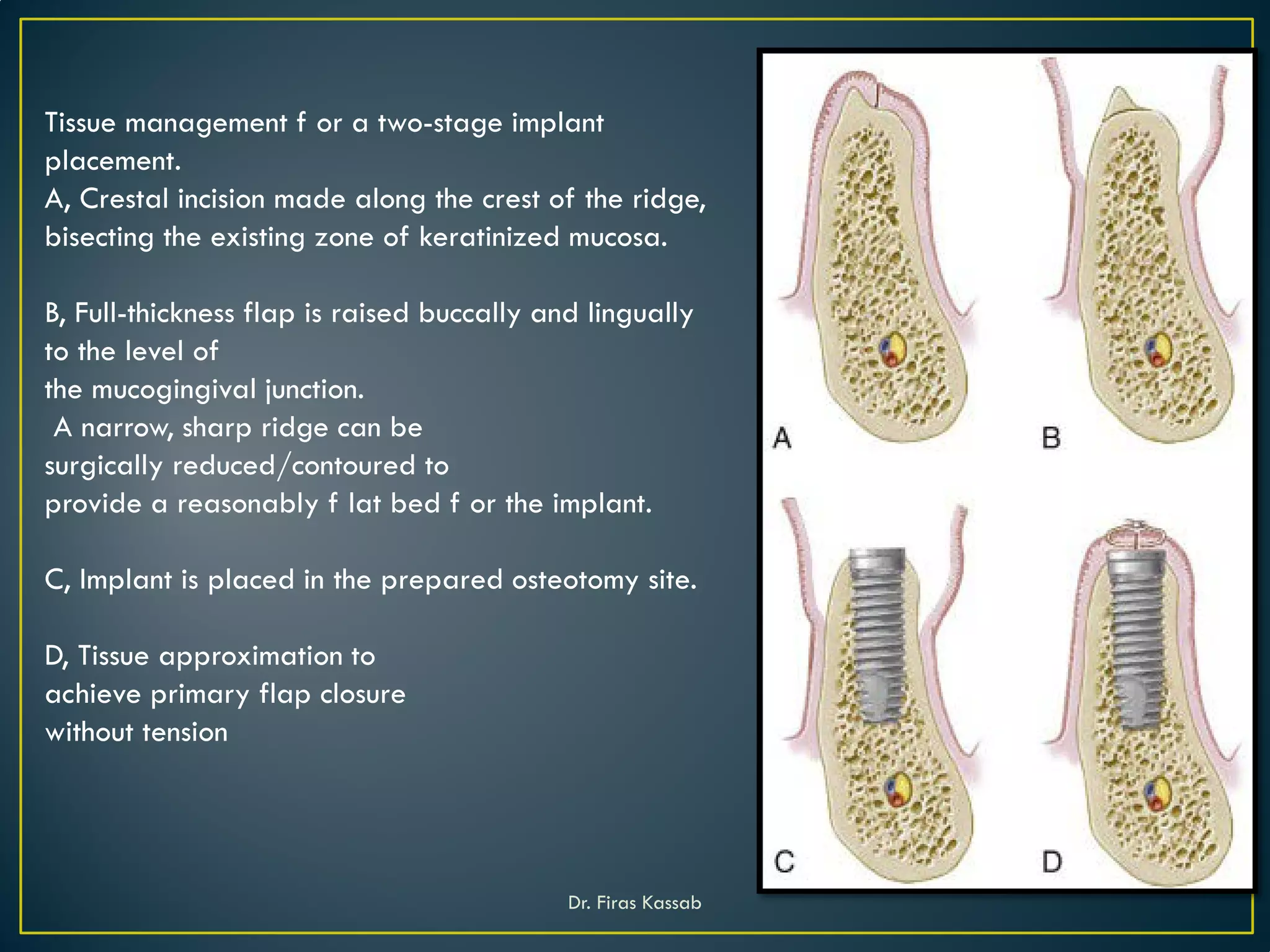 Implant surgical procedure | PDF