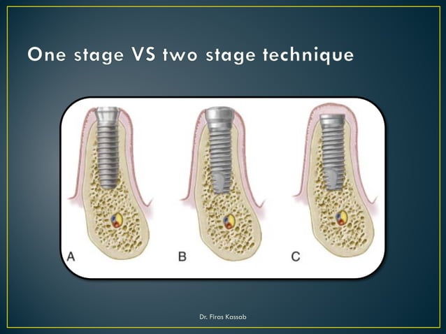 Implant surgical procedure | PDF | Dental Health | Diseases and Conditions