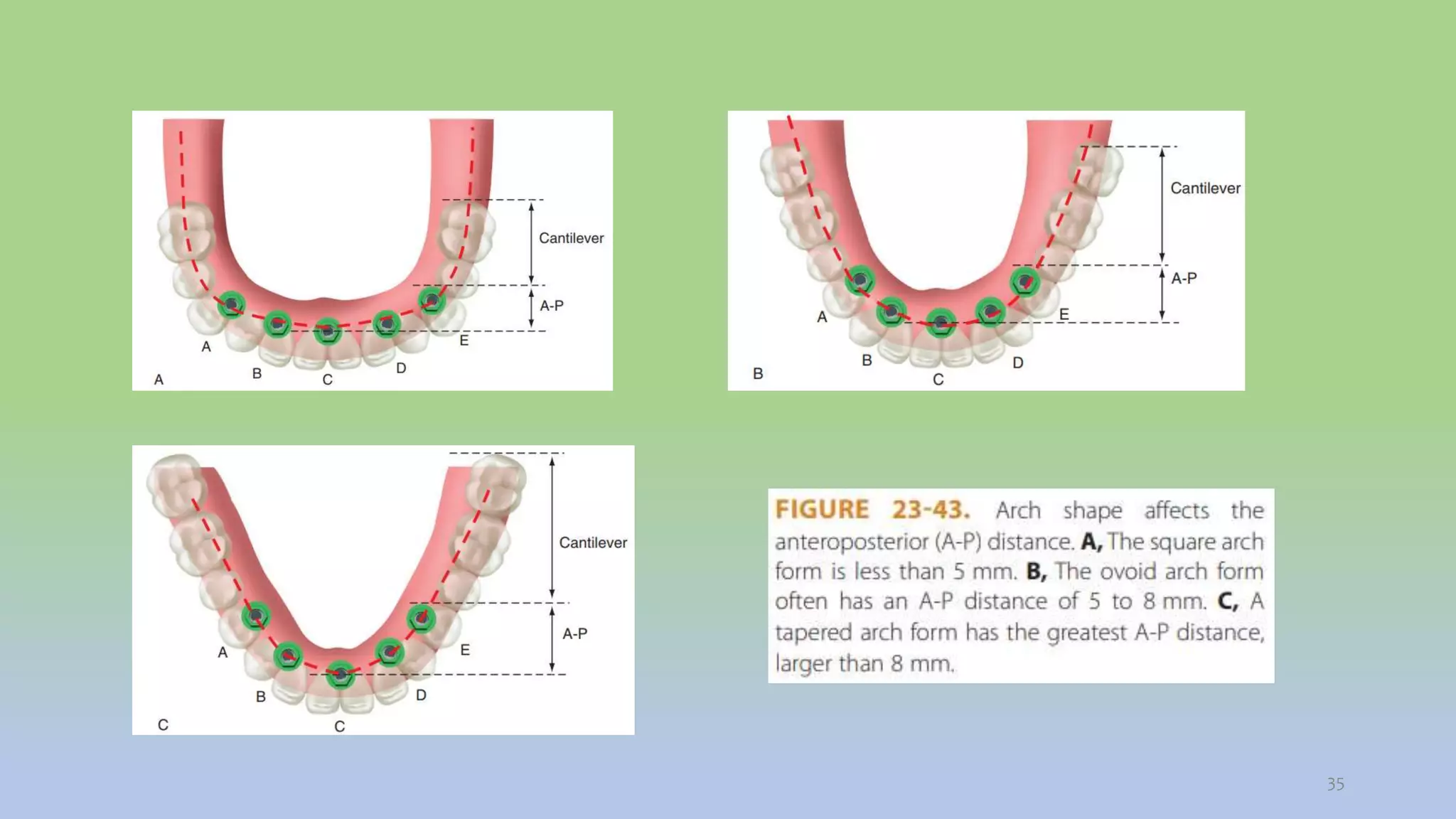 Implant treatment plan for completely edentulous patient | PPTX