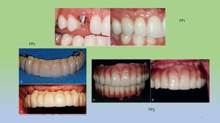 Implant treatment plan for completely edentulous patient | PPTX