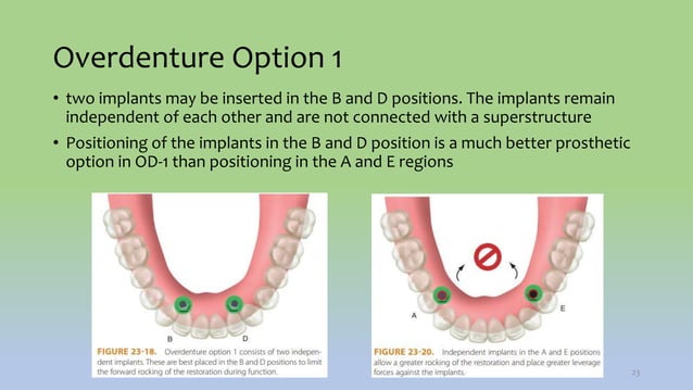 Implant treatment plan for completely edentulous patient | PPTX