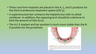 Implant treatment plan for completely edentulous patient | PPTX