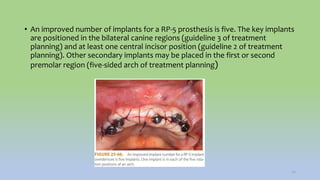 Implant treatment plan for completely edentulous patient | PPTX