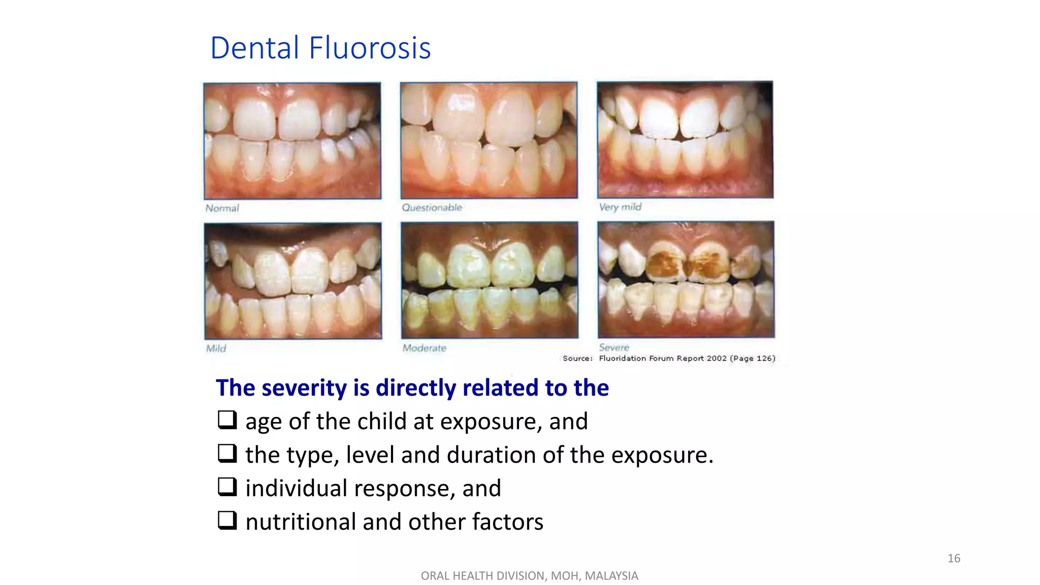 Implementation of water fluoridation in malaysia (malay) | PPTX