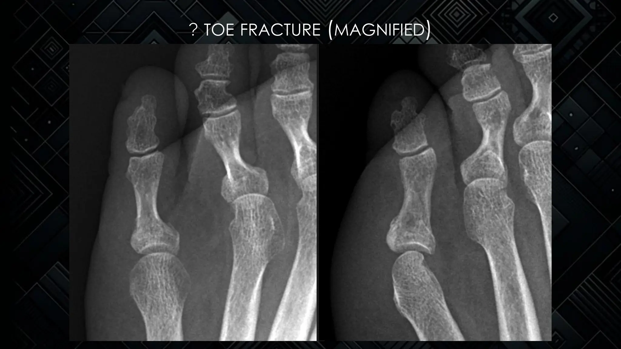 Implementing Ai For Fracture Detection Accuracy And Impact Assessment