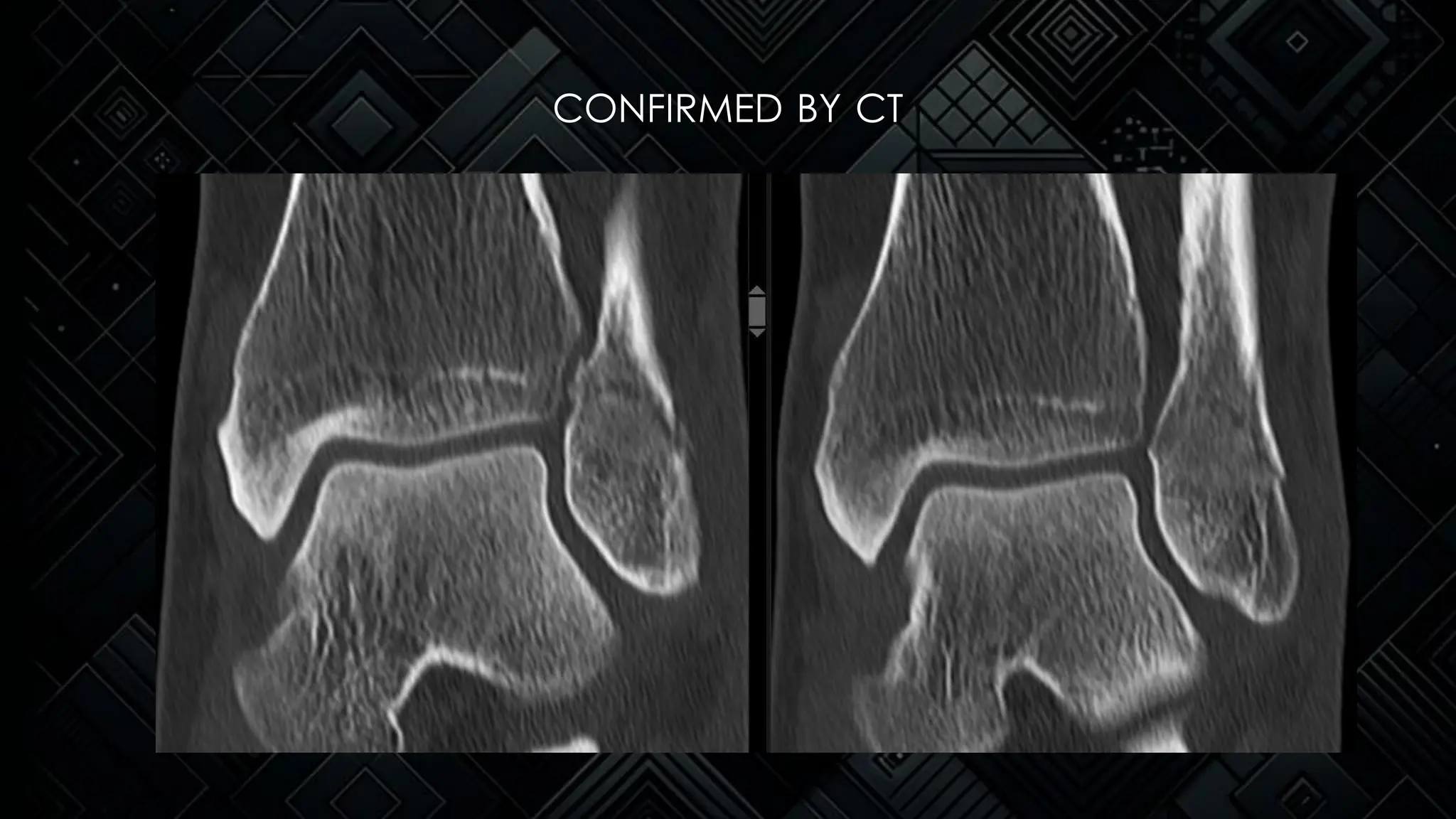Implementing AI for Fracture Detection: Accuracy and Impact Assessment ...