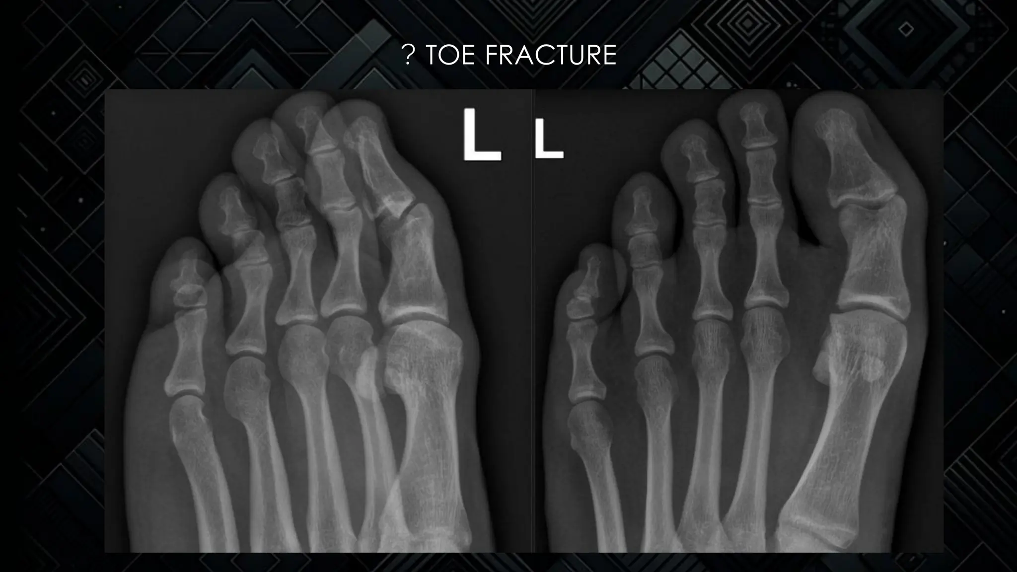 Implementing AI for Fracture Detection: Accuracy and Impact Assessment ...