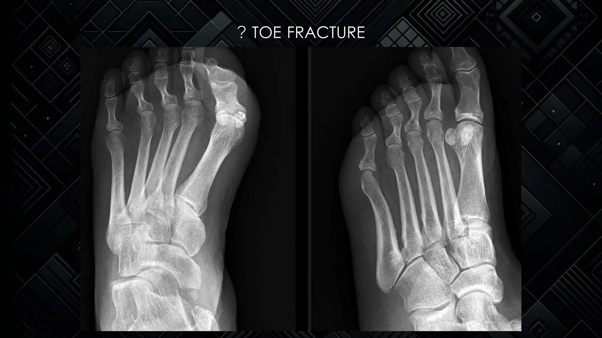Implementing AI for Fracture Detection: Accuracy and Impact Assessment ...