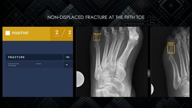 Implementing AI for Fracture Detection: Accuracy and Impact Assessment ...