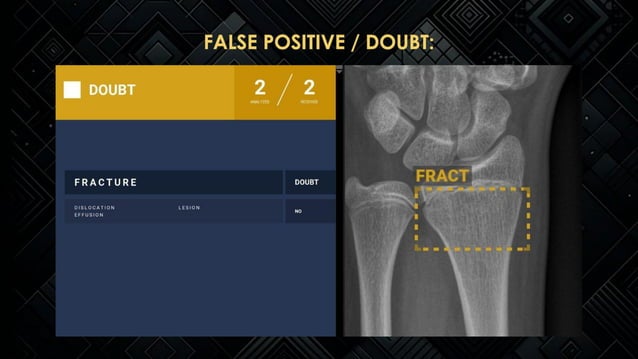Implementing Ai For Fracture Detection Accuracy And Impact Assessment Ppt
