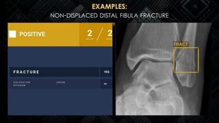 Implementing AI for Fracture Detection: Accuracy and Impact Assessment ...