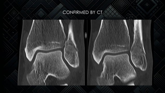Implementing Ai For Fracture Detection Accuracy And Impact Assessment