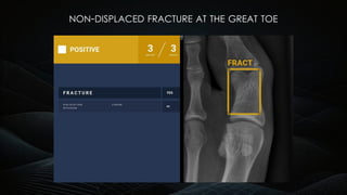 Implementing AI for Fracture Detection: Accuracy and Impact Assessment ...