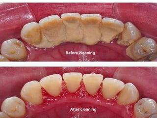 Importance and Benefits of Teeth Cleaning | PDF