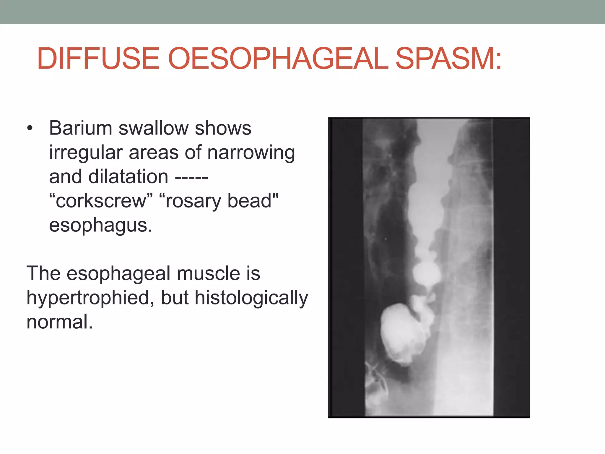 barium studies in gi pathologies | PPTX