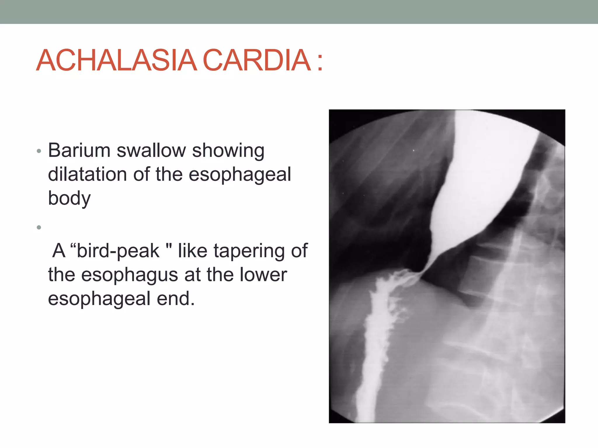 barium studies in gi pathologies | PPTX