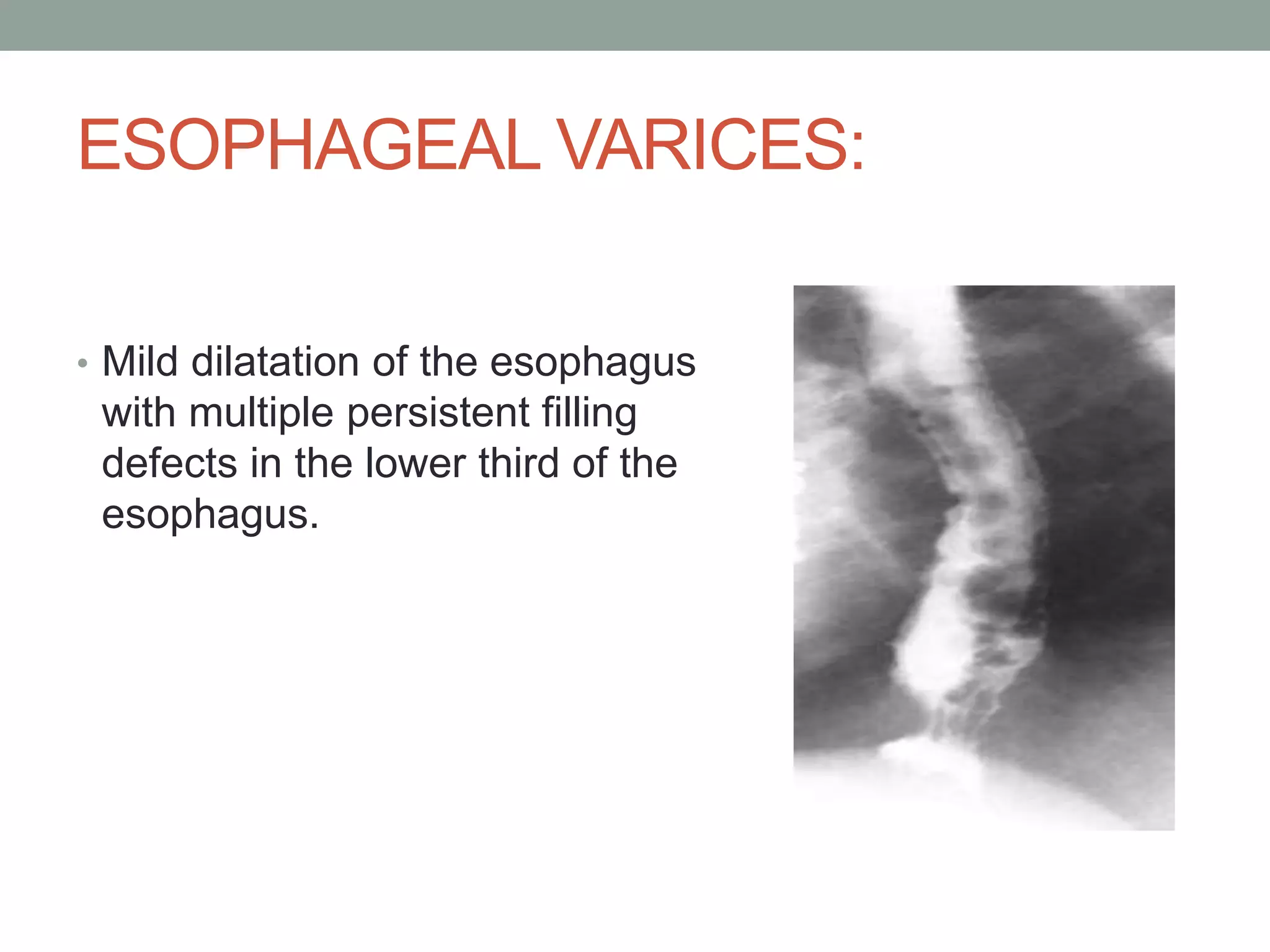 barium studies in gi pathologies | PPTX