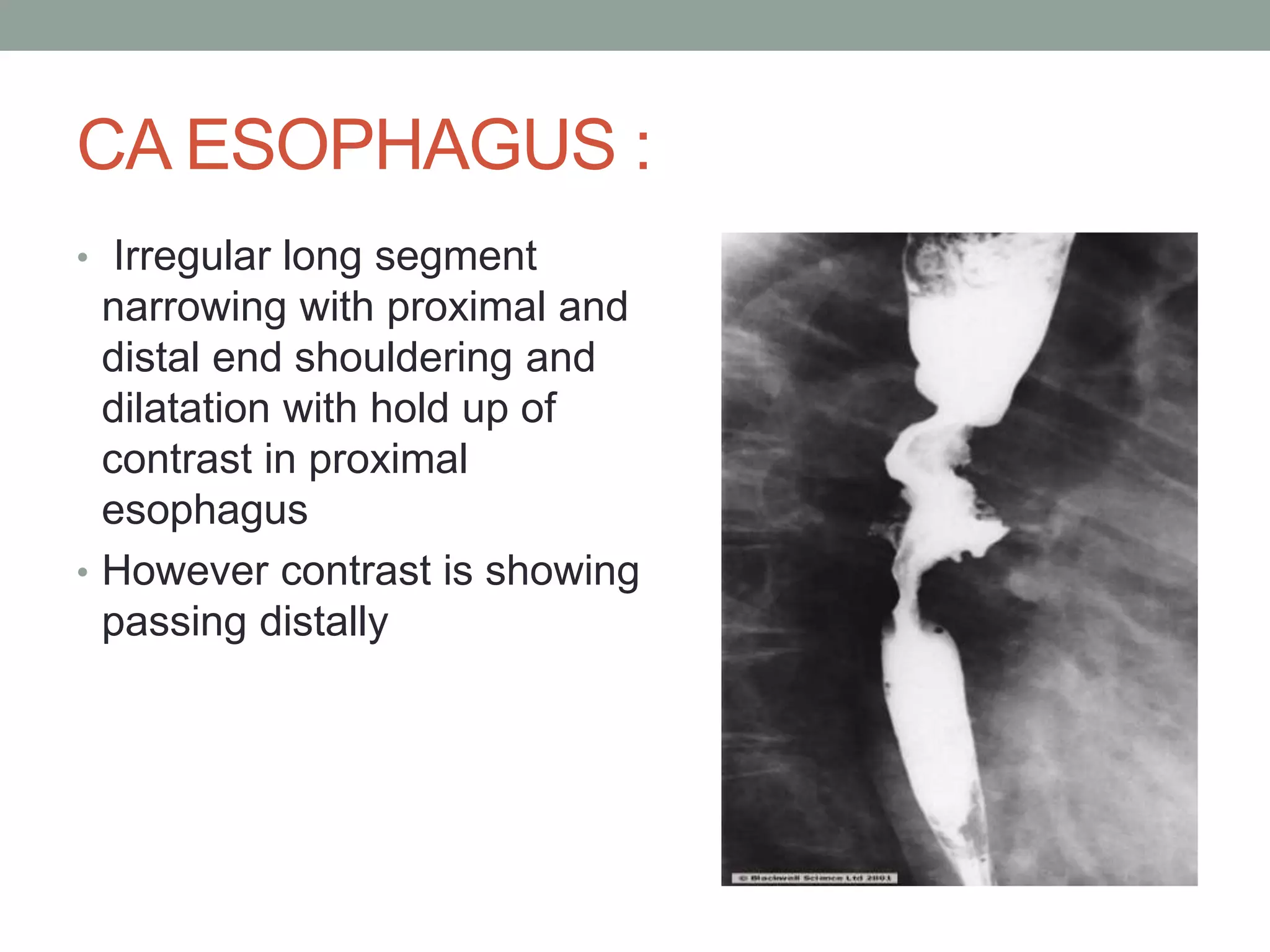 barium studies in gi pathologies | PPTX