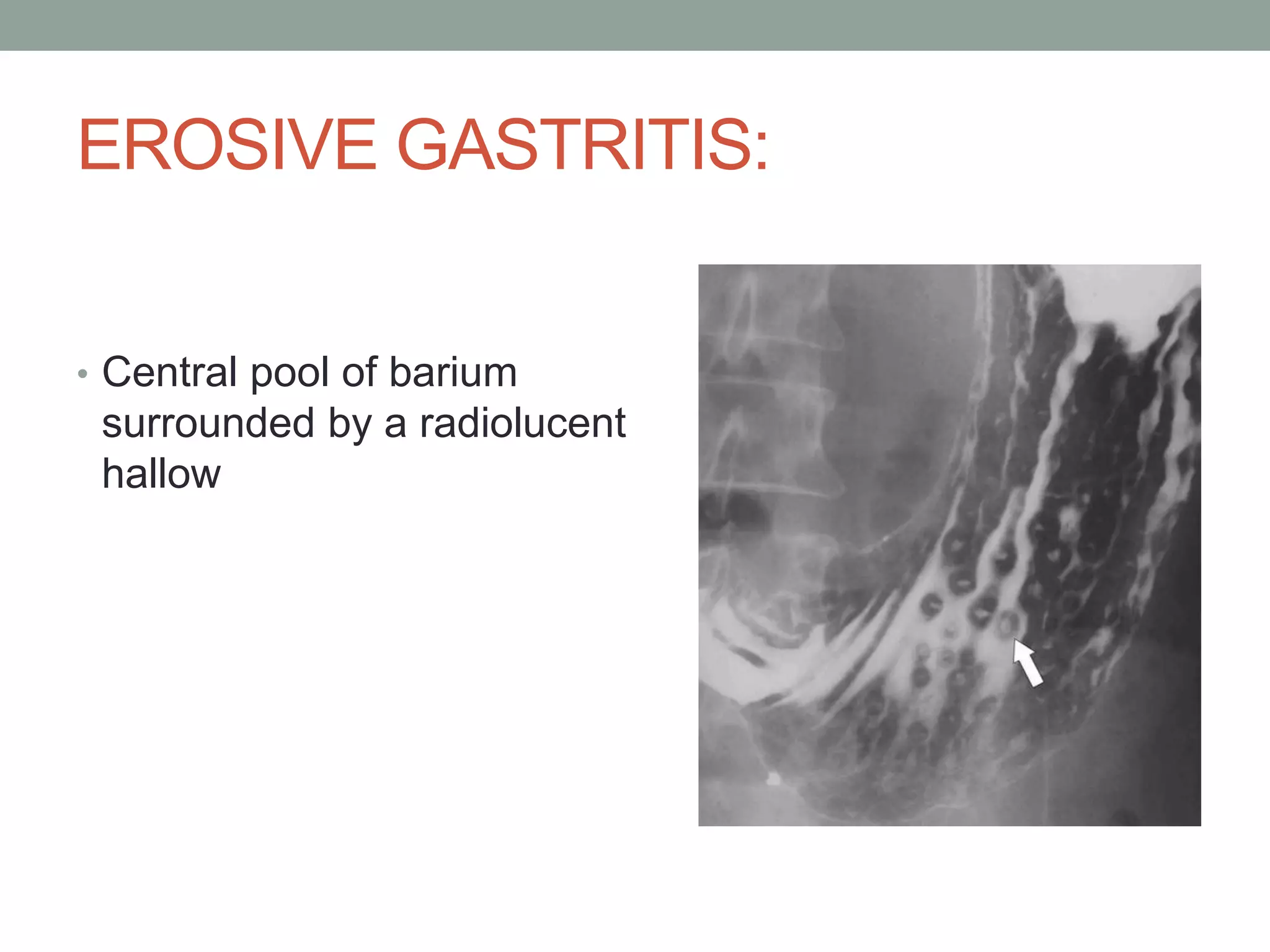 barium studies in gi pathologies | PPTX