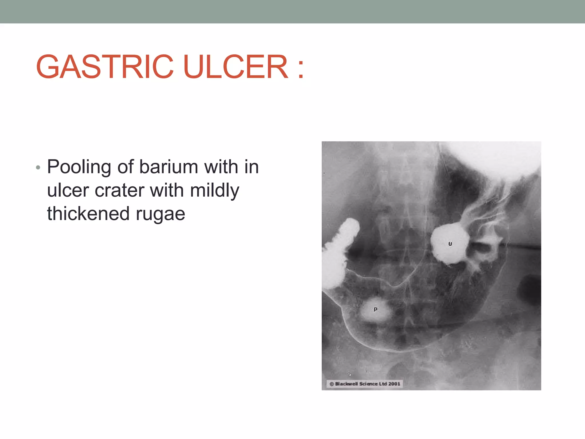 barium studies in gi pathologies | PPTX