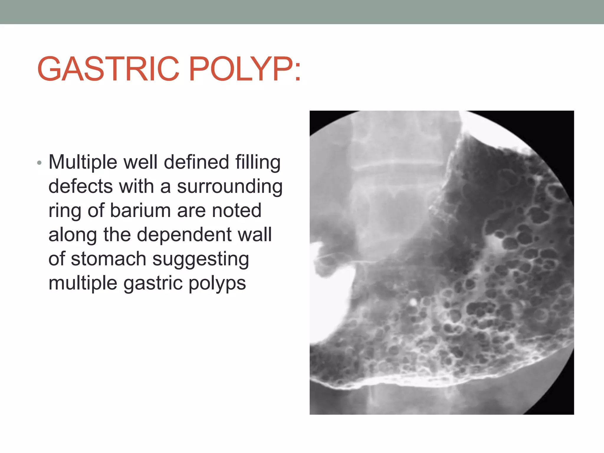 barium studies in gi pathologies | PPTX