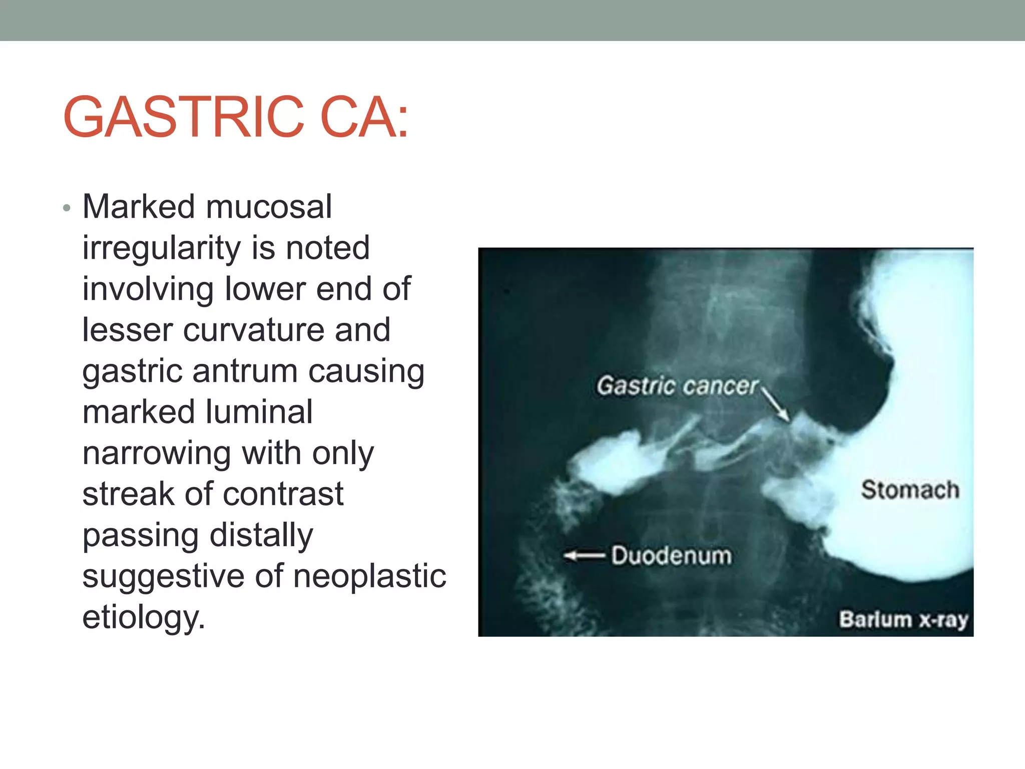 barium studies in gi pathologies | PPTX