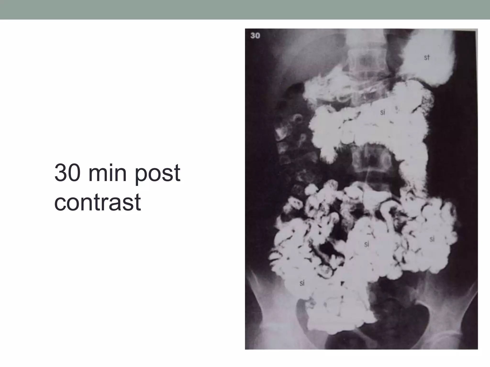 barium studies in gi pathologies | PPTX