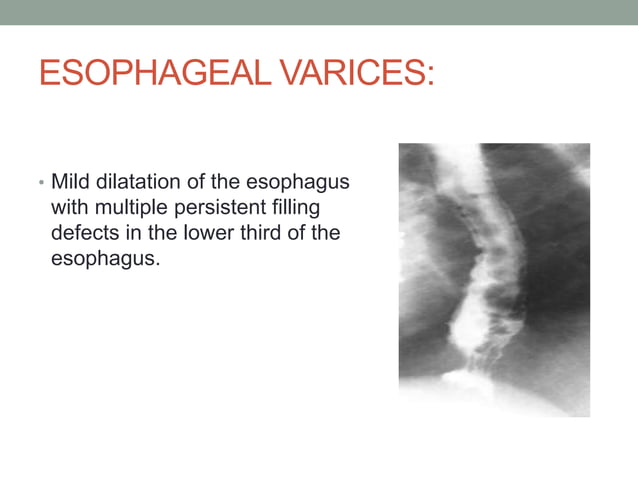 barium studies in gi pathologies | PPTX | Digestive Disorders ...