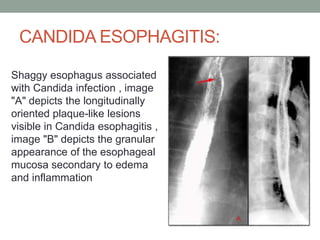 barium studies in gi pathologies | PPTX